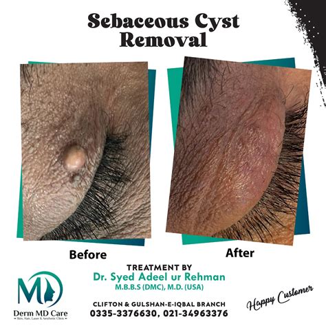 Scrotal Cyst Treatment