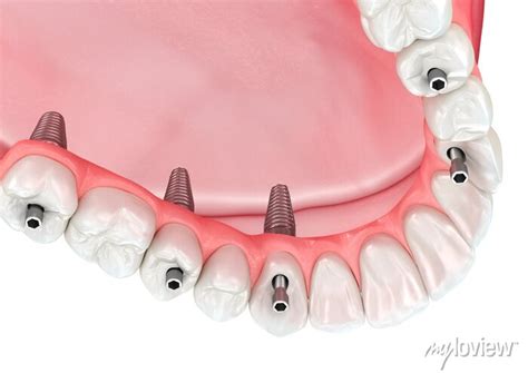 Maxillary Prosthesis With Gum All On 6 System Supported By Implants