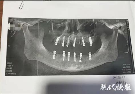 Man Has 23 Teeth Extracted And 12 Implants Done On The Same Day Dies Shortly After