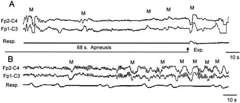 Treatment Of Apneustic Respiratory Disturbance With A Serotonin