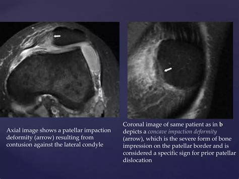 Patello Femoral Joint Mri Pptx
