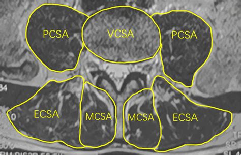 Measurement Method Of Relative Cross Sectional Area Of Paraspinal