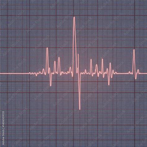Electrocardiogram Show St Elevation Myocardial Infarction Stemi Pattern Heart Attack