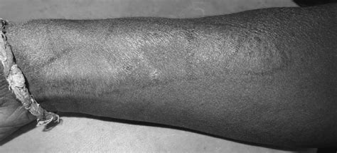 Hypopigmented Patch Over Right Hand Along With Tattoo Download