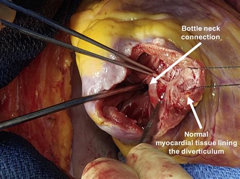 Intraoperative Surgical Specimen Of The Diverticulum Demonstrating Download Scientific Diagram