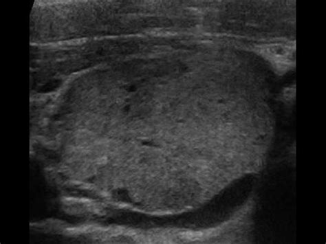 Head And Neck 41 Thyroid Gland Case 413 Thyroid Malignant