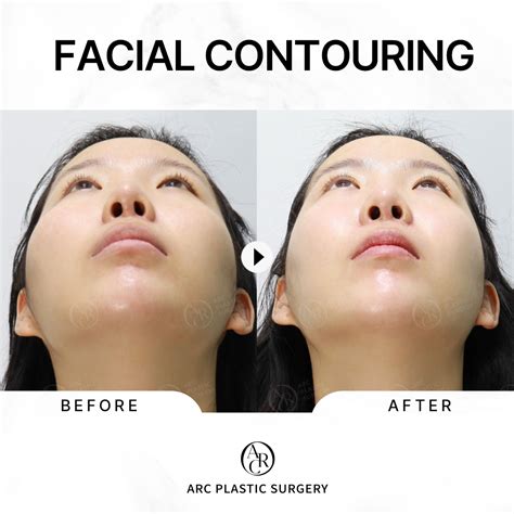 Facial Contouring