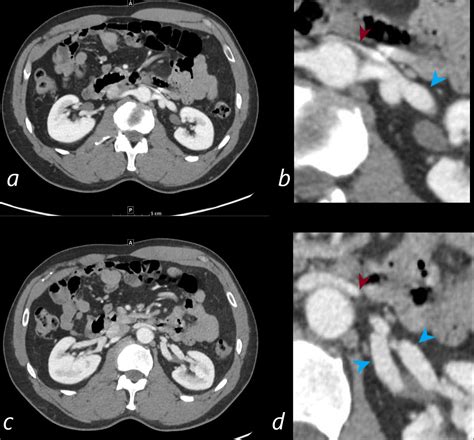 Renal Venous Hypertension The Common Vein