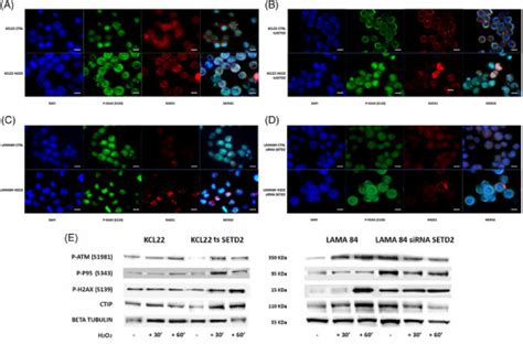 Setd2 Loss Of Function Is A Recurrent Event In Advanced‐phase Chronic Myeloid Leukemia And