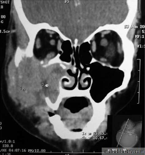 Paranasal Sinus Pptx دكتور علي Muhadharaty