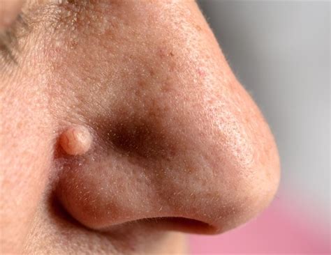 What Do Female Genital Warts Look Like Nhs