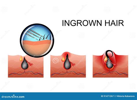 Ingrown Hair Pimple Ripening Cartoon Vector 91471267