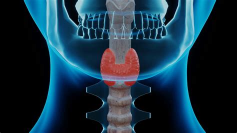 Nodular Goiter In Human Body 3d Render Stock Motion Graphics Sbv 338591633 Storyblocks