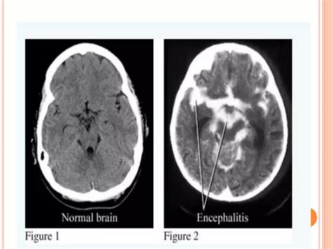 Encephalitis And Nursing Care Pptx