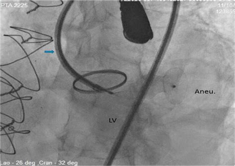 Lv Angiogram In Long Axis View Done With Sheath Marked By Arrow