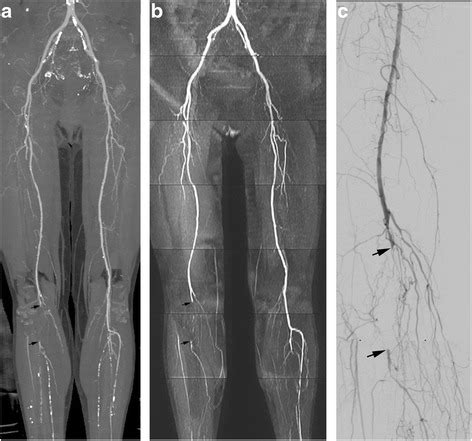 The Diagnostic Value Of Non Contrast Enhanced Quiescent Interval Single