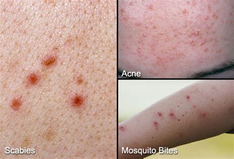 Healthy Life Scabies