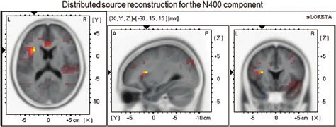 Sloreta Maps For The N400 Component For The Contrast Between Disgust