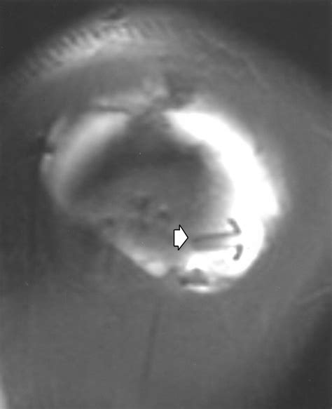 Rotator Cuff Surgery Gone Wrong At Carroll Zabala Blog