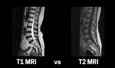 What To Expect During Lumbar Mri