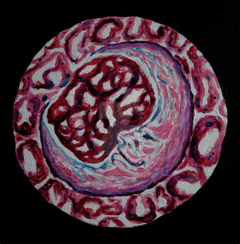 Histobestiary Rapid Progressive Glomerulitis By Kingsofevilart On