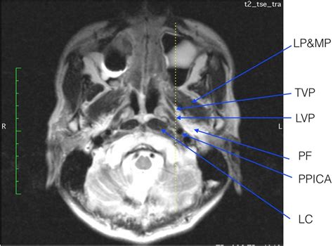Tensor Veli Palatini Mri