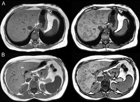 Fatty Liver Mri