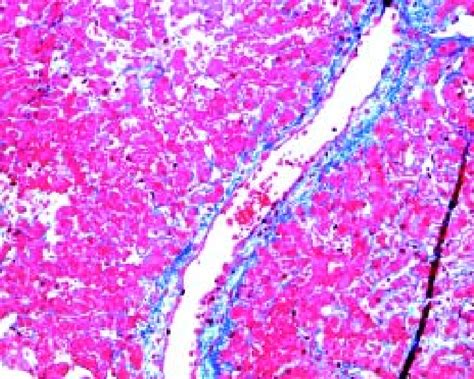 Liver Biopsy This Liver Biopsy Demonstrates Centrilobular Congestion