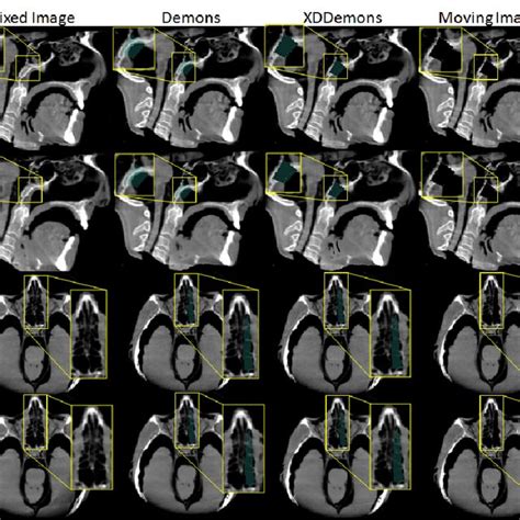 Illustration Of Registration Results For Conventional Demons And
