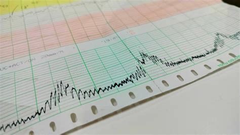 Ekg Chart In Cardiac Polyclinic Patients Stock Image Image Of Number