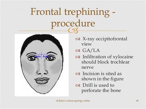 External Approaches To Sinus Surgery
