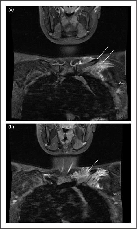 Figure 2 From Acute Presentation Of Clavicular Osteomyelitis In An 8