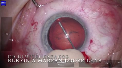 Rle Phacodonesis Youtube