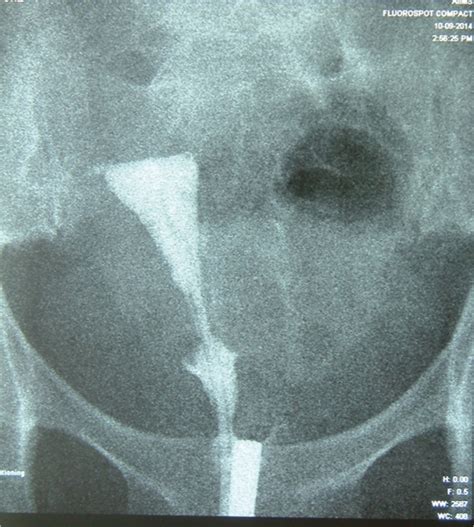 Genital Tuberculosis And Infertility Fertility Science And Research