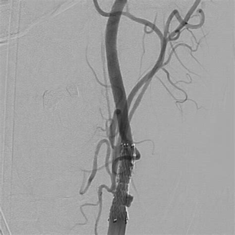 Postprocedural Cta Showing Tici 2c Reperfusion Patient 2 Cta Download Scientific Diagram