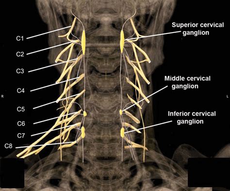Complications Of Stellate Ganglion Block Sgb Anesthesia Key