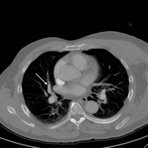 Ct Angiogram Showed A Pe Involving The Medial Segment Of The Right
