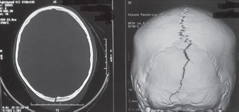 Noncontrast Computed Tomography Head Showing Undisplace Open I