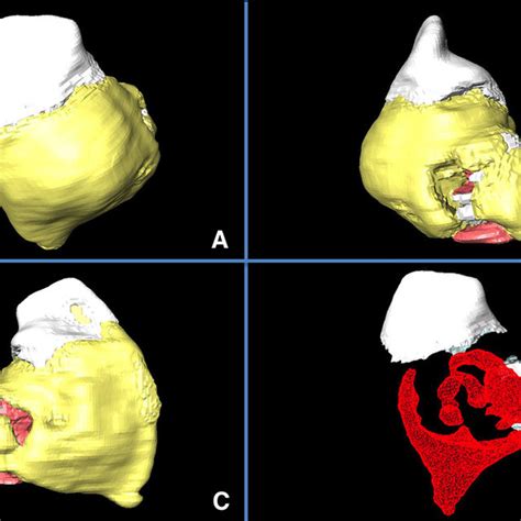 The Different Types Of Dens Invaginatus Oehlers Classification