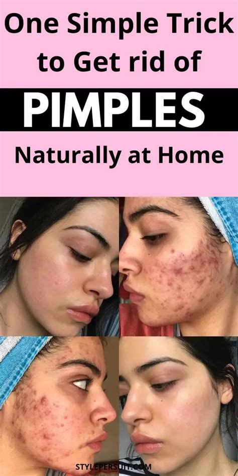 How To Get Rid Of Pimples 9 Remedies For Pimples On Face