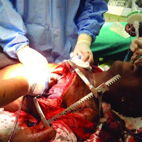 Entrance Edendale Hospital Figure 3 Emergency Room Thoracotomy For Download Scientific