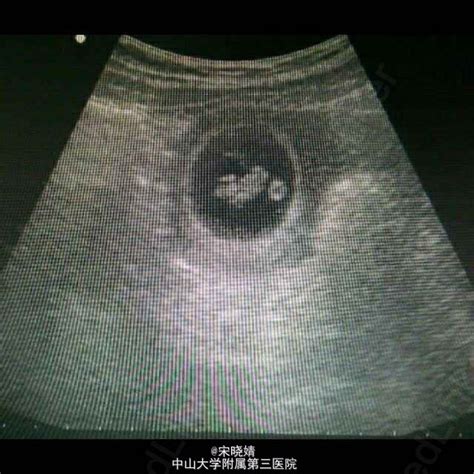 带状疱疹合并妊娠 医联