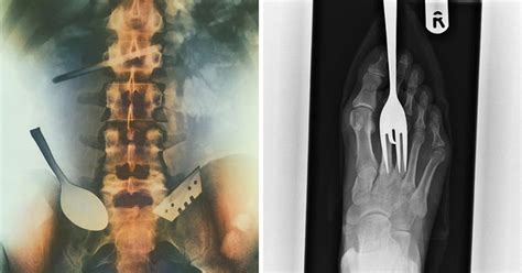 25 Crazy Things Seen In X Rays Ebaums World