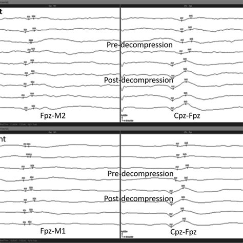 A Representative Intraoperative Sep Improvement A Representative Download Scientific Diagram