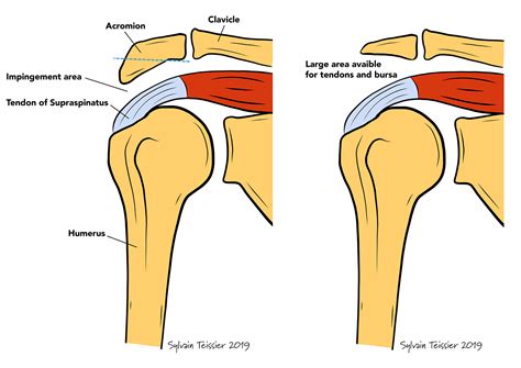 Acromioplasty On Behance