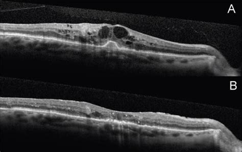 Choosing Candidates For Vitrectomy Among Refractory Dme Cases Retinal Physician