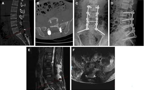 Sagittal And Cross Sectional Ct Images At The Postoperative Month 1