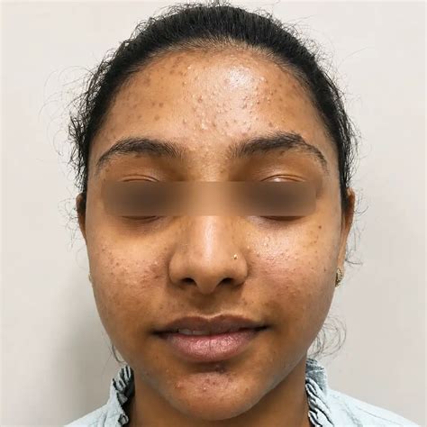 Foods That Cause Pimples And Oily Skin Mango Oily Food And Sugar