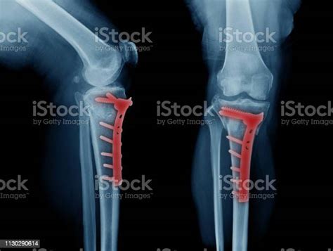 Fraktur Tibia Proksimal Dengan Fiksasi Internal Ap Dan Tampilan Lateral