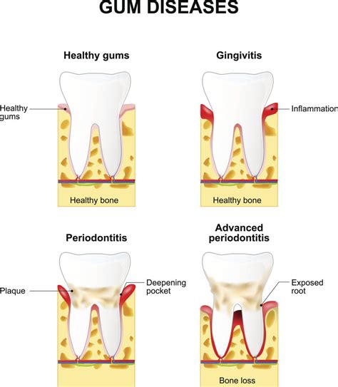 Periodontitis